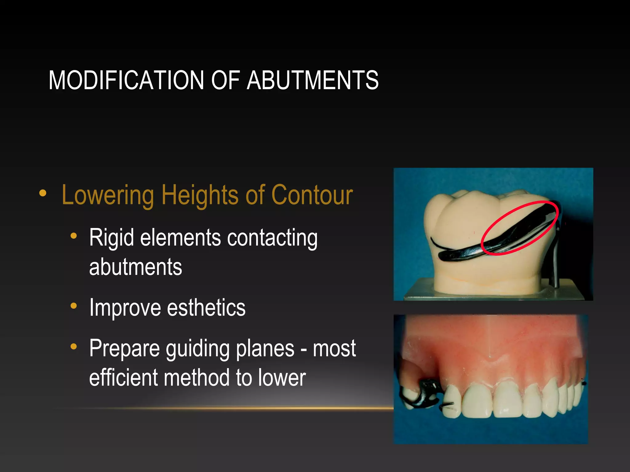 removable partial denture survey lines, path of insertion, guide planes ...