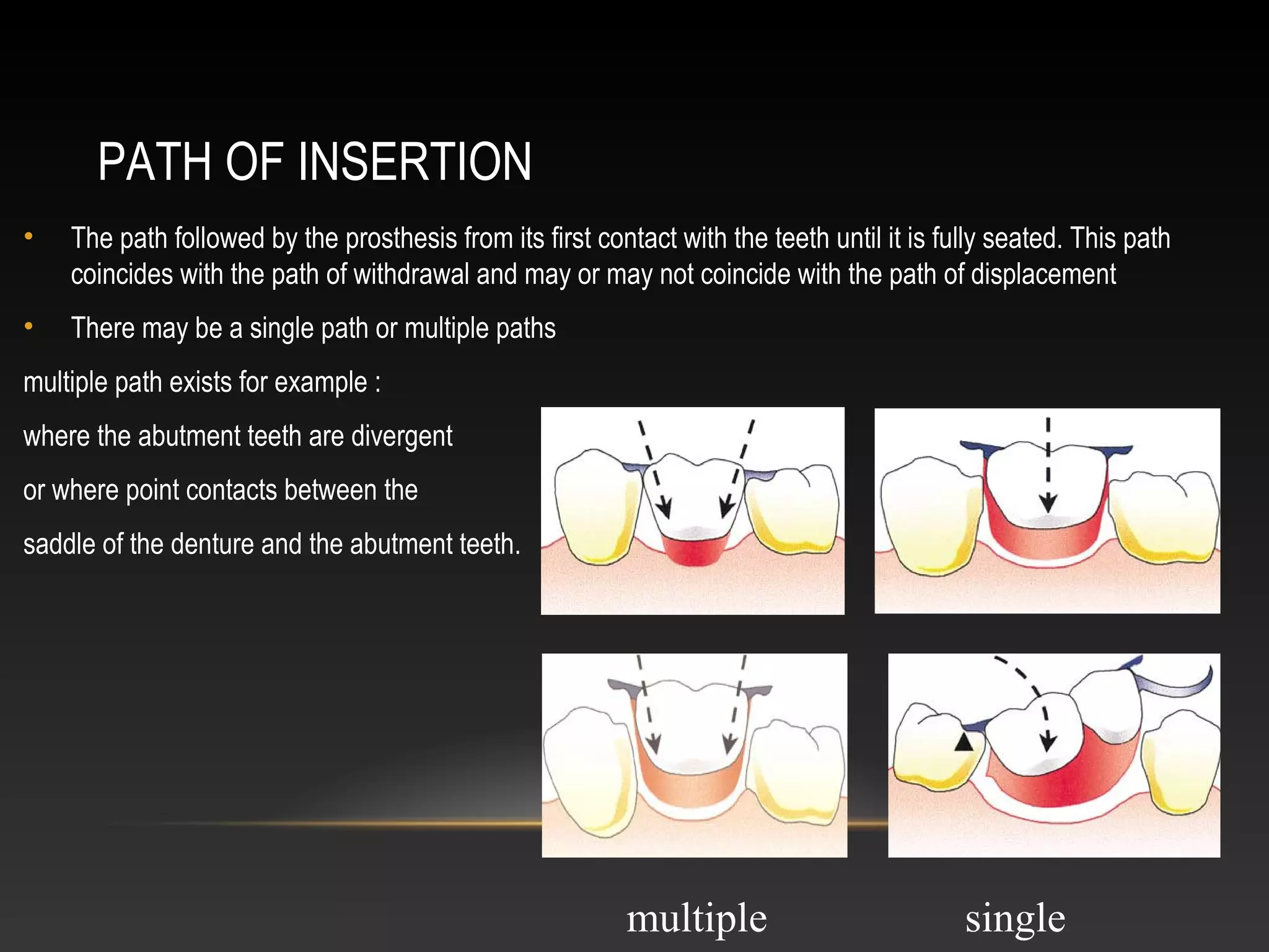 removable partial denture survey lines, path of insertion, guide planes | PPT