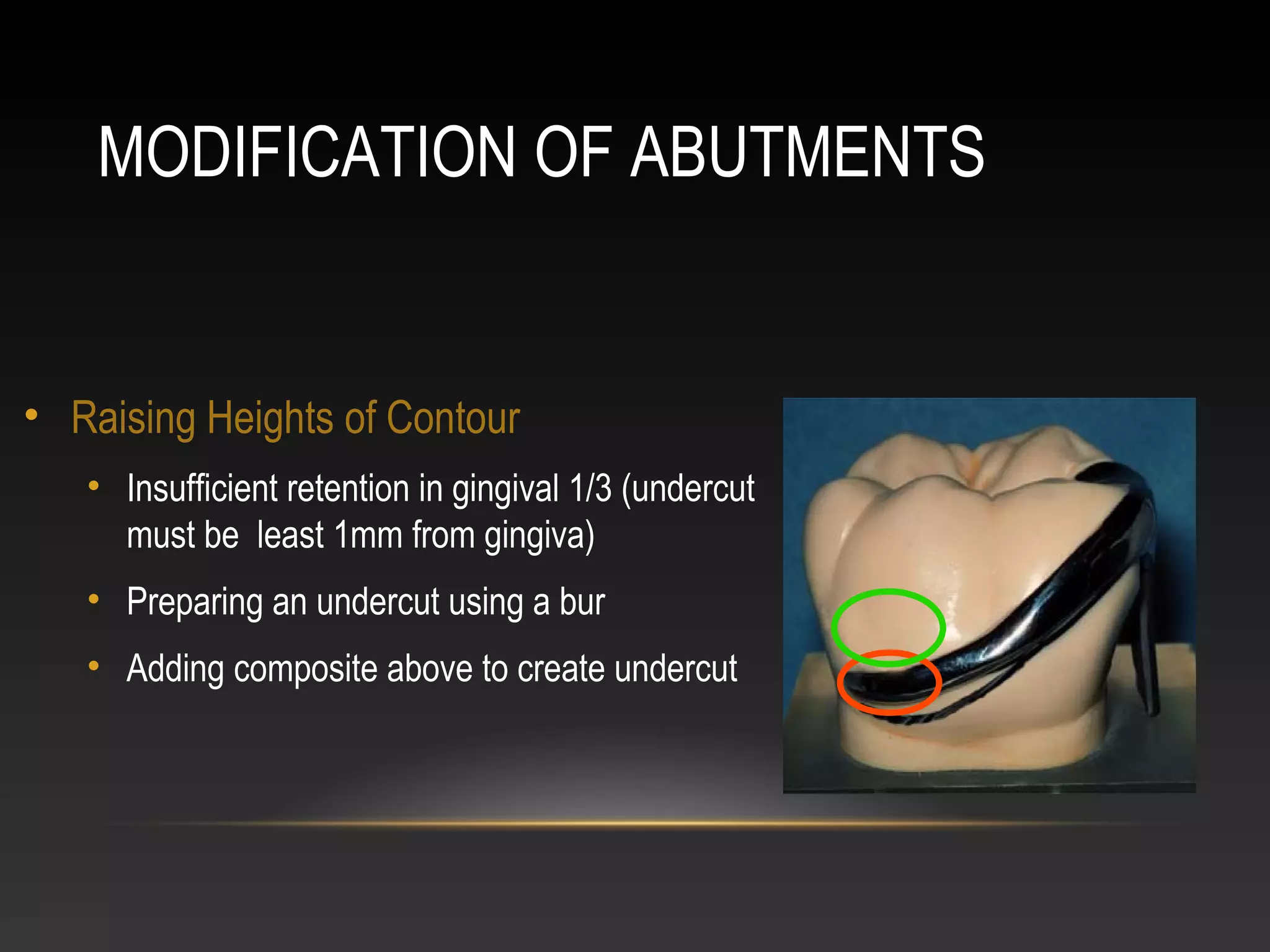 removable partial denture survey lines, path of insertion, guide planes ...