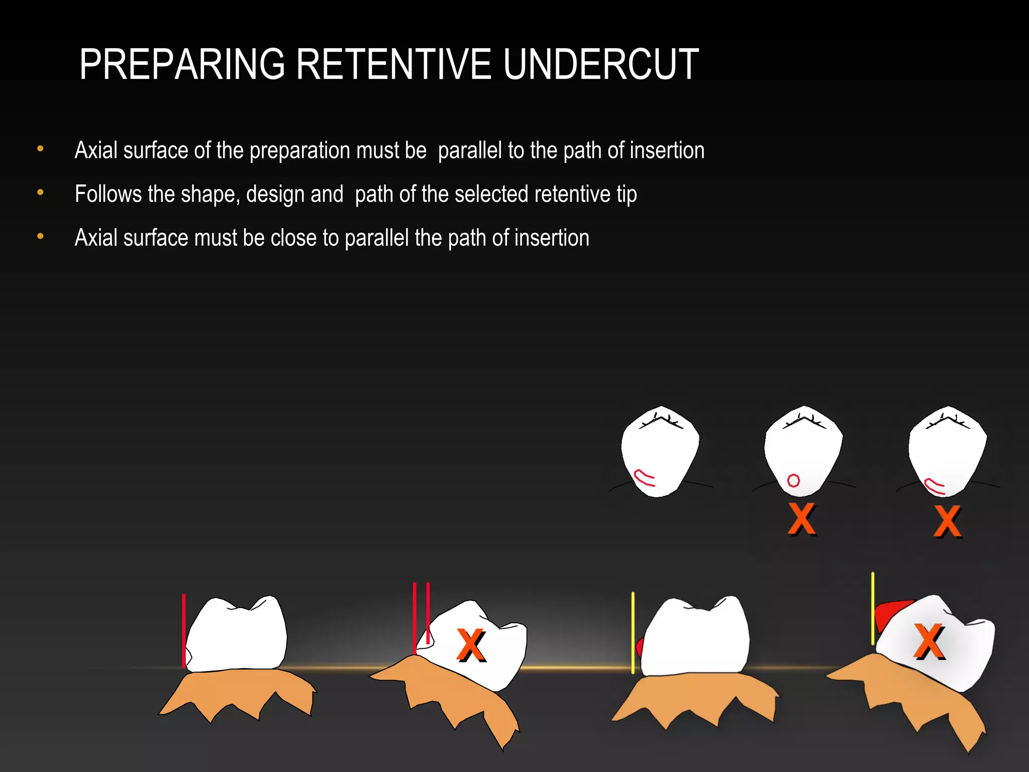 removable partial denture survey lines, path of insertion, guide planes ...