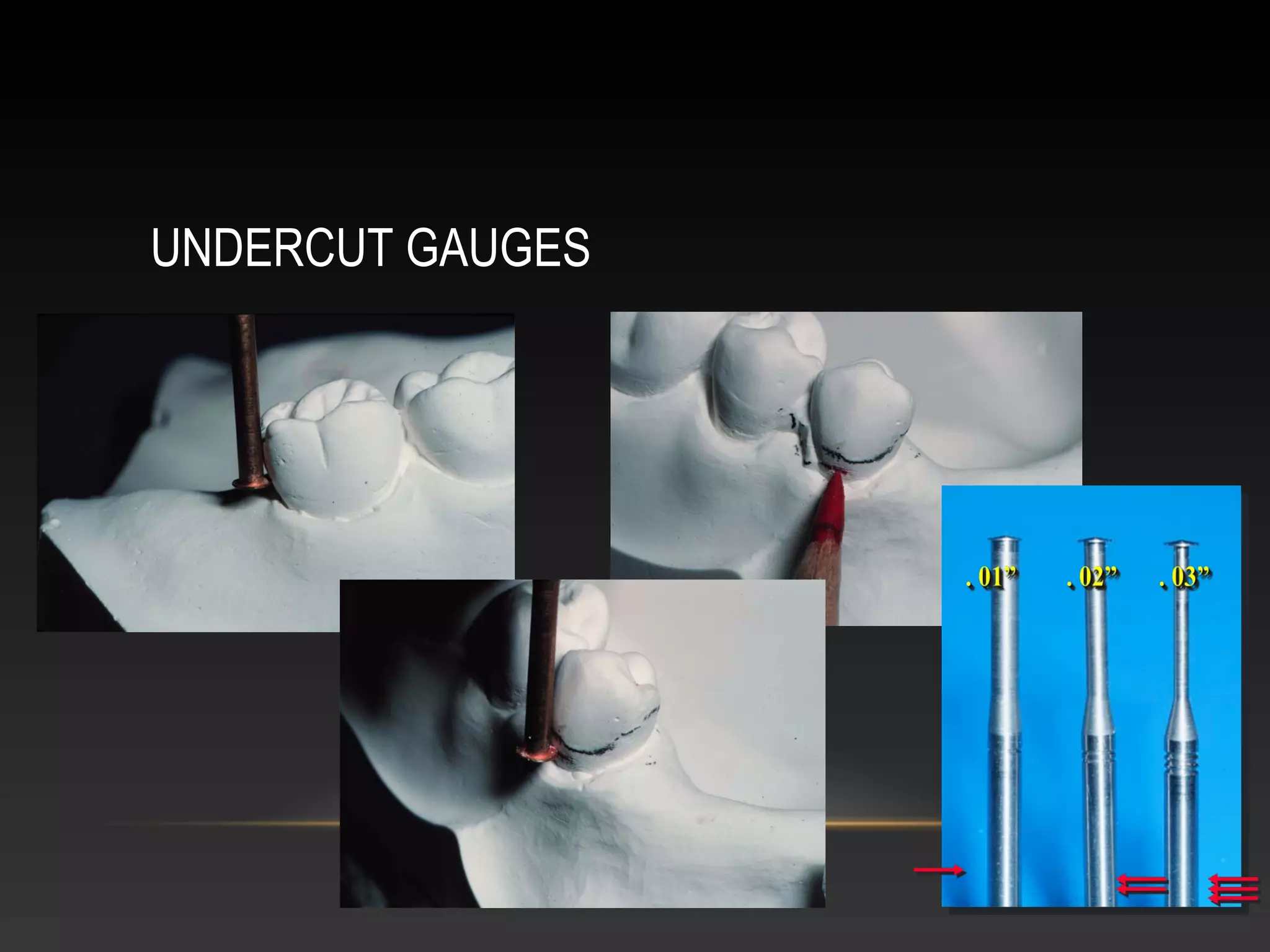 removable partial denture survey lines, path of insertion, guide planes ...