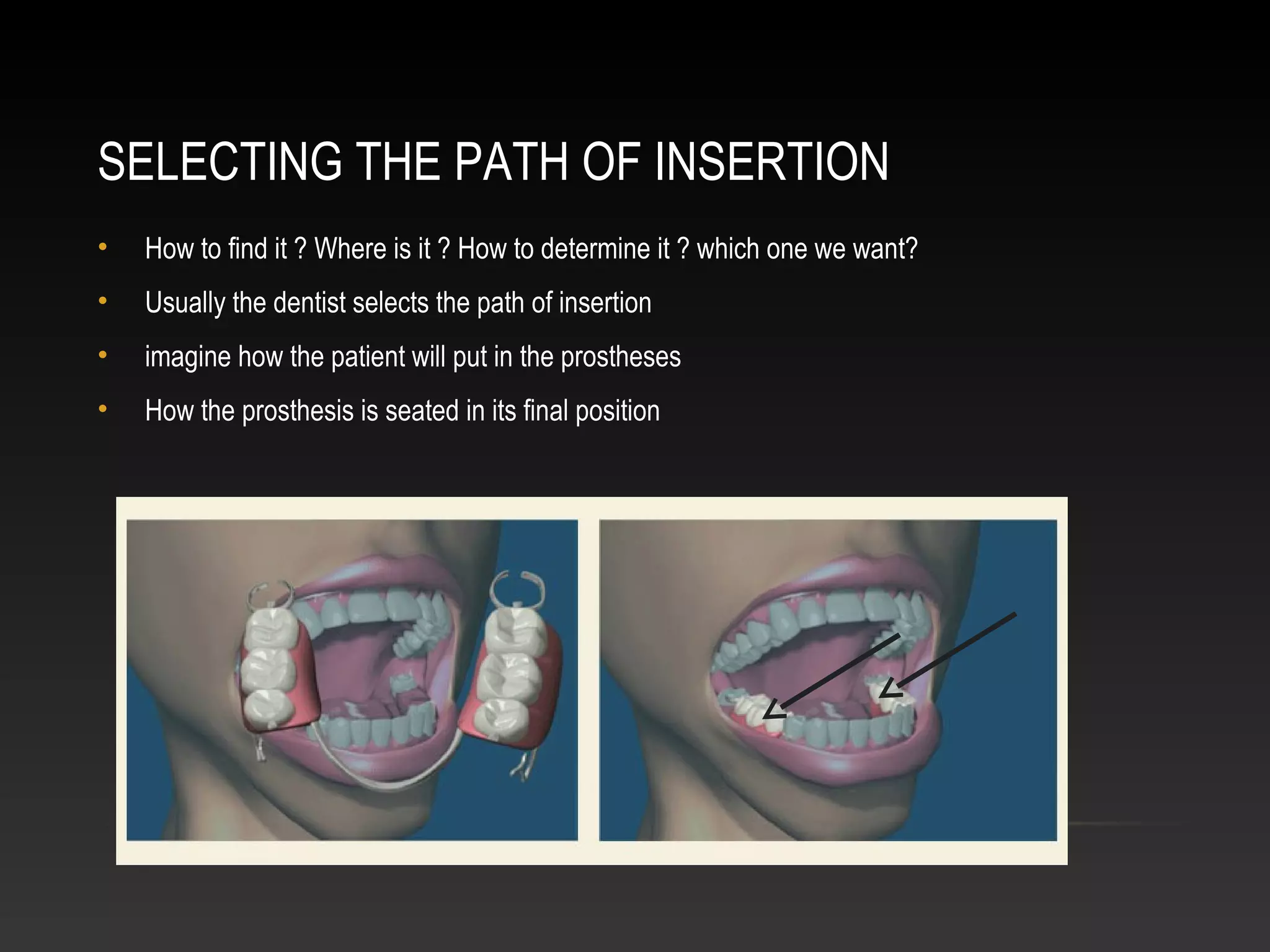removable partial denture survey lines, path of insertion, guide planes ...