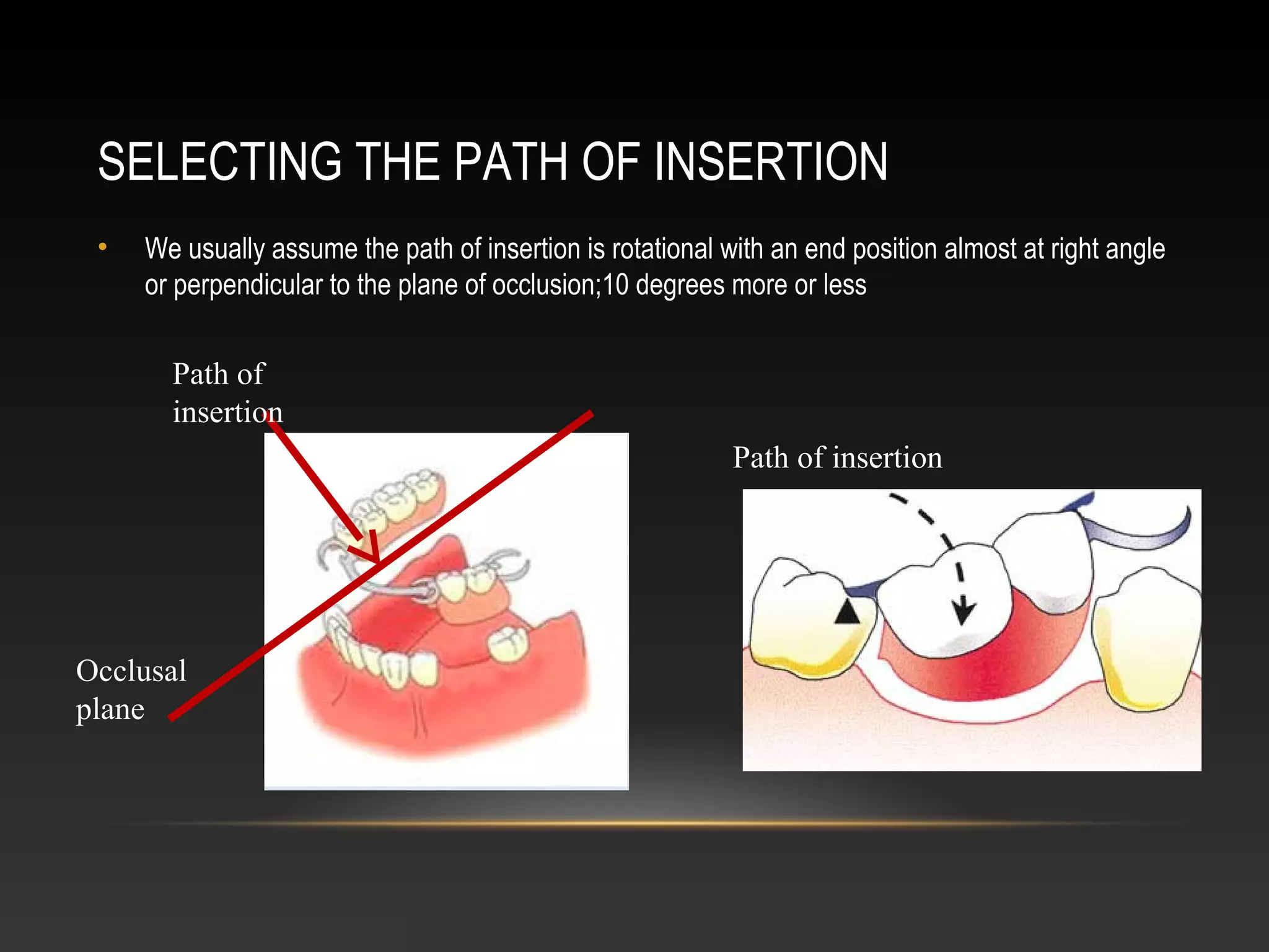 removable partial denture survey lines, path of insertion, guide planes ...