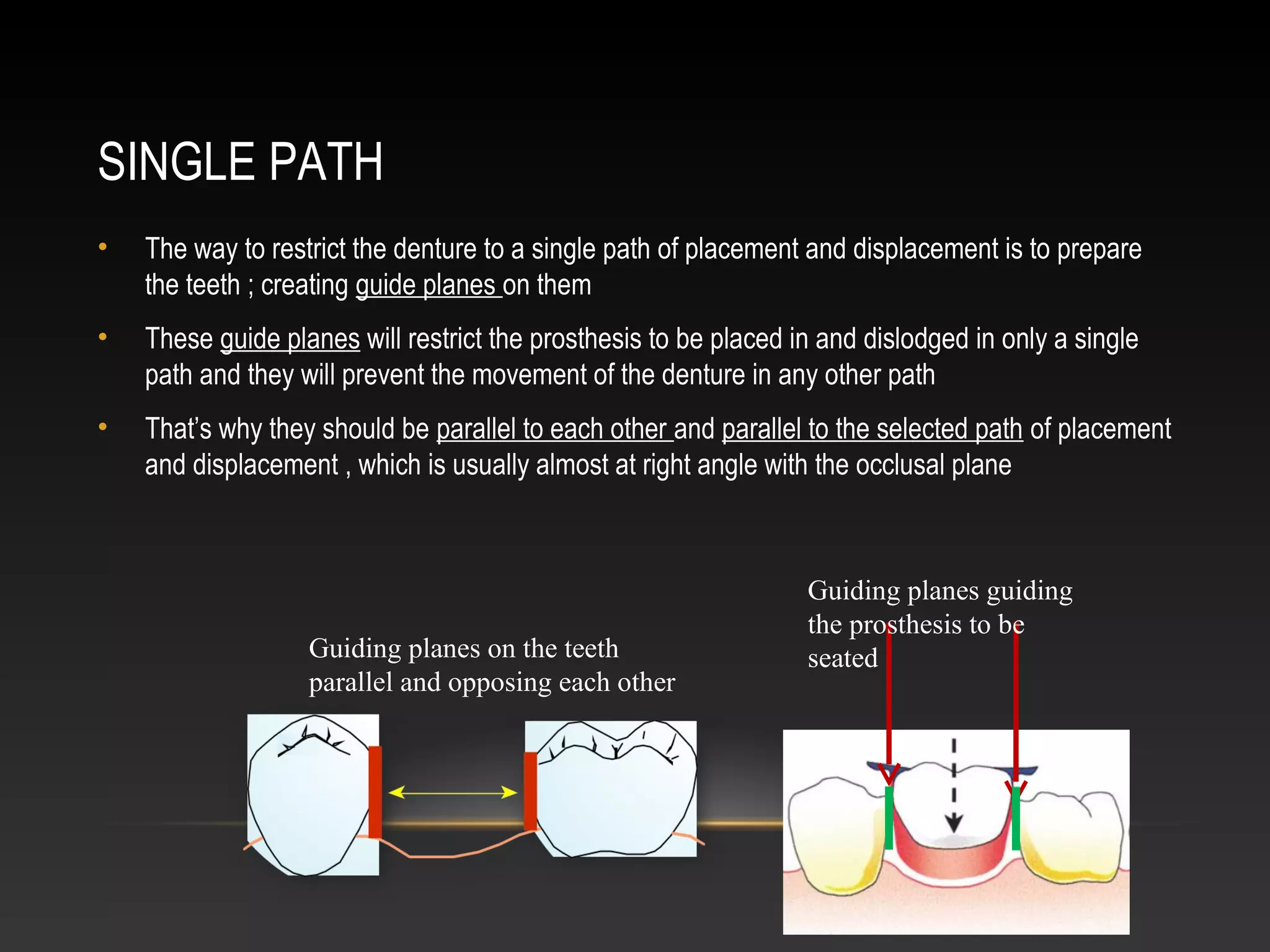 removable partial denture survey lines, path of insertion, guide planes | PPT