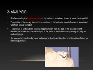 removable partial denture survey lines, path of insertion, guide planes ...