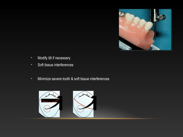 removable partial denture survey lines, path of insertion, guide planes ...