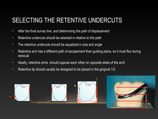 removable partial denture survey lines, path of insertion, guide planes ...