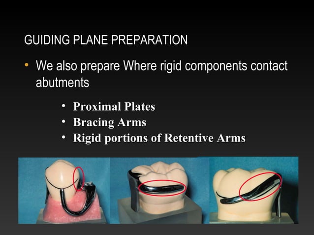 removable partial denture survey lines, path of insertion, guide planes