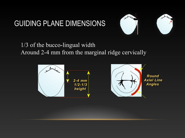removable partial denture survey lines, path of insertion, guide planes ...
