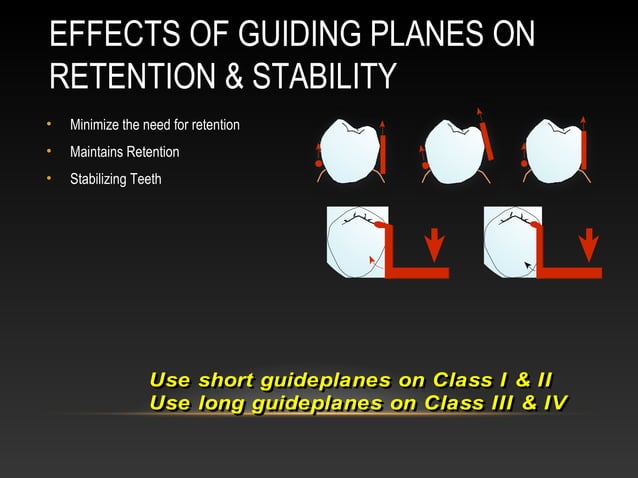 removable partial denture survey lines, path of insertion, guide planes ...
