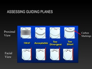 removable partial denture survey lines, path of insertion, guide planes ...