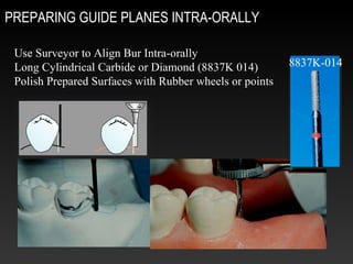 removable partial denture survey lines, path of insertion, guide planes ...