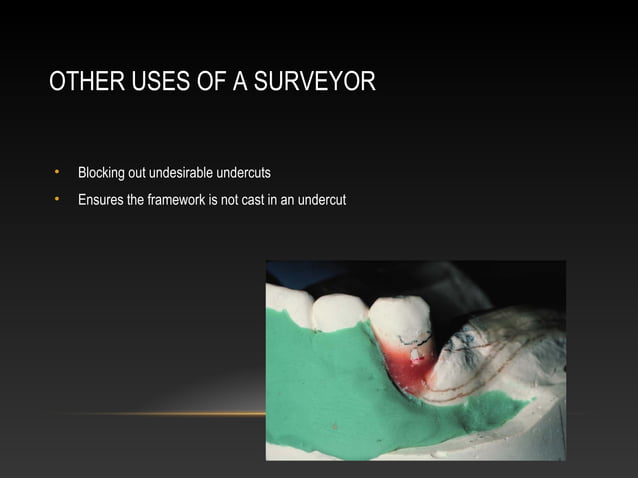 removable partial denture survey lines, path of insertion, guide planes ...