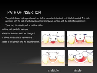 removable partial denture survey lines, path of insertion, guide planes ...
