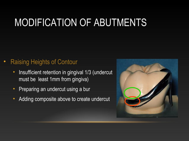 removable partial denture survey lines, path of insertion, guide planes ...