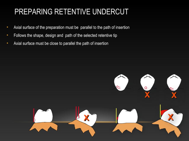 removable partial denture survey lines, path of insertion, guide planes ...