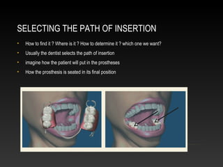 removable partial denture survey lines, path of insertion, guide planes ...