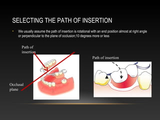 removable partial denture survey lines, path of insertion, guide planes | PPT