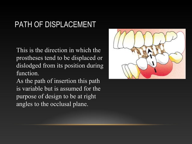removable partial denture survey lines, path of insertion, guide planes ...