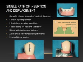 removable partial denture survey lines, path of insertion, guide planes ...