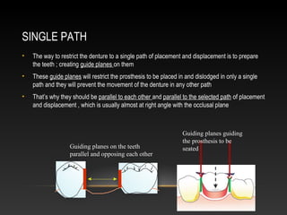 removable partial denture survey lines, path of insertion, guide planes ...