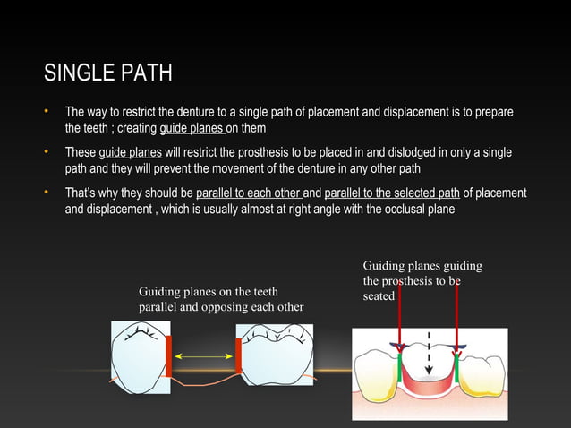 removable partial denture survey lines, path of insertion, guide planes ...