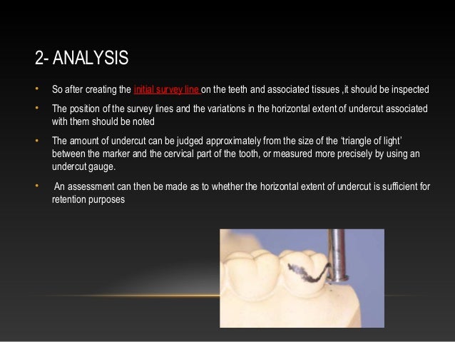 removable partial denture survey lines, path of insertion, guide plan…