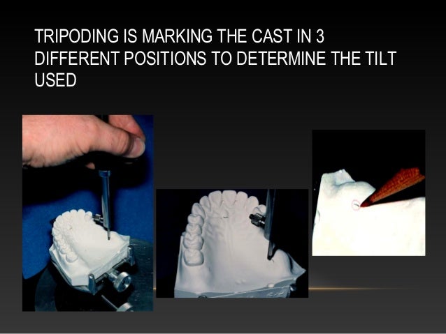 removable partial denture survey lines, path of insertion, guide plan…