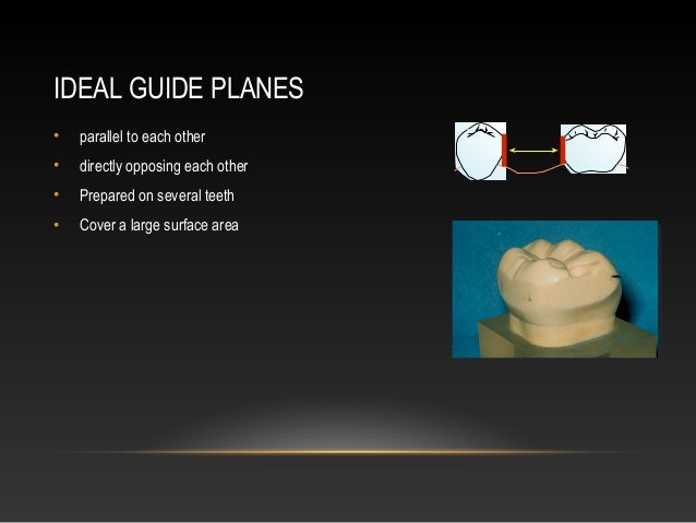 removable partial denture survey lines, path of insertion, guide plan…