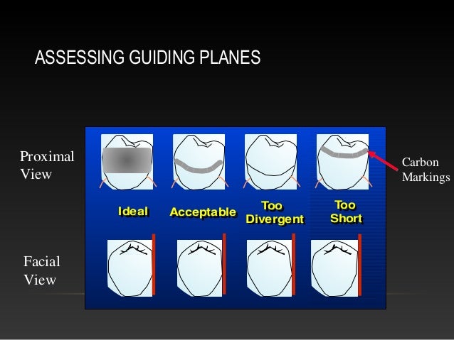 removable partial denture survey lines, path of insertion, guide plan…