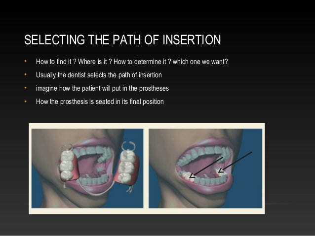 removable partial denture survey lines, path of insertion, guide plan…