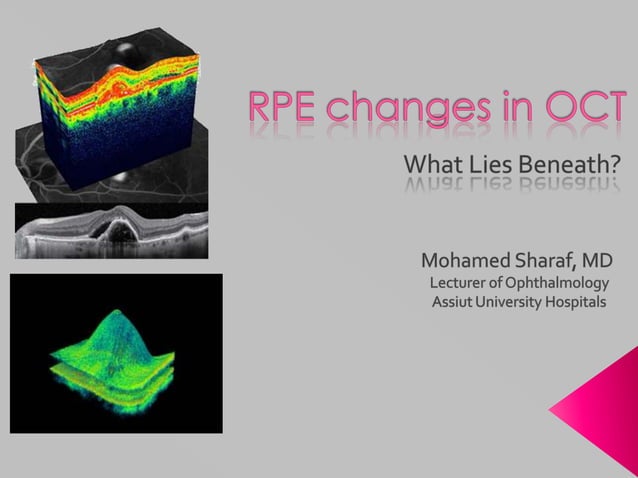 RPE changes in OCT | PPTX | Eye and Vision Conditions | Diseases and ...
