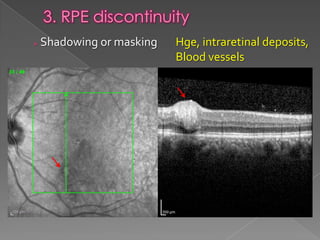 RPE changes in OCT | PPTX