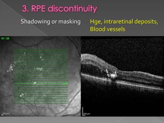 RPE changes in OCT | PPTX