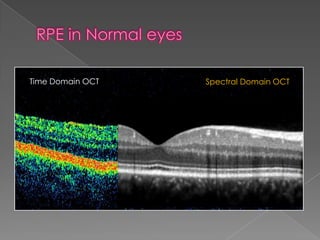 RPE changes in OCT | PPTX