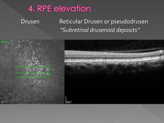 RPE changes in OCT | PPTX