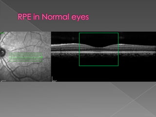 RPE changes in OCT | PPTX