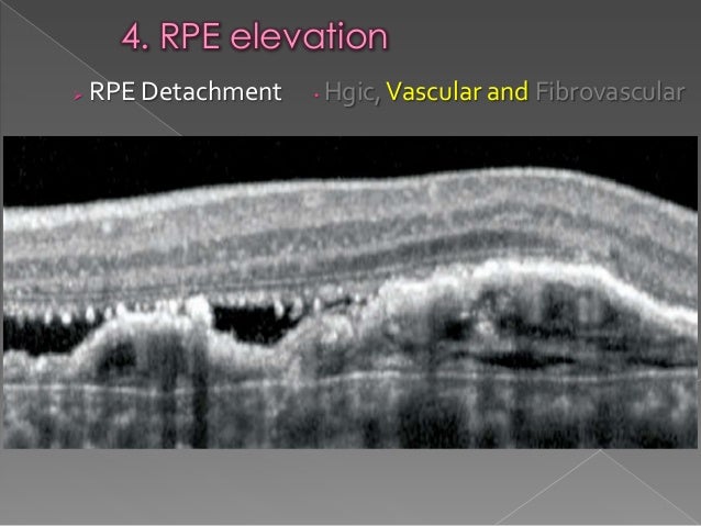 RPE changes in OCT