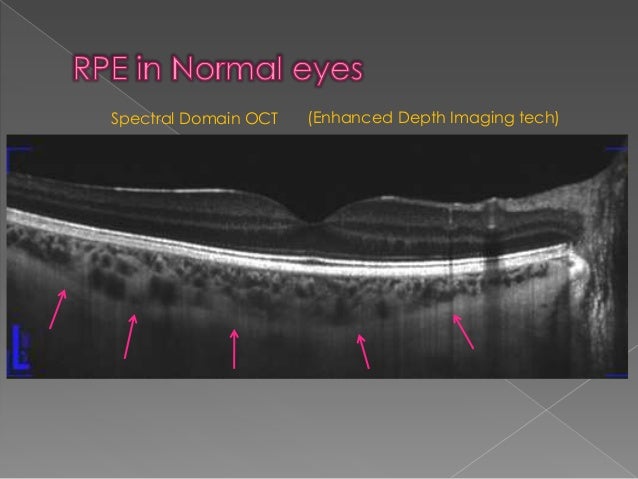 RPE changes in OCT
