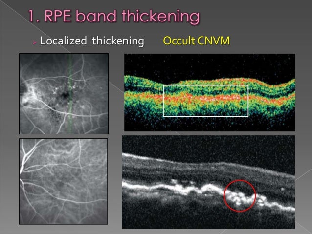 Rpe Dropout On Oct : Ophthalmology Dx: What’s Behind This Bilateral ...