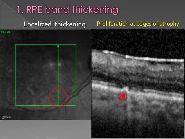 RPE changes in OCT