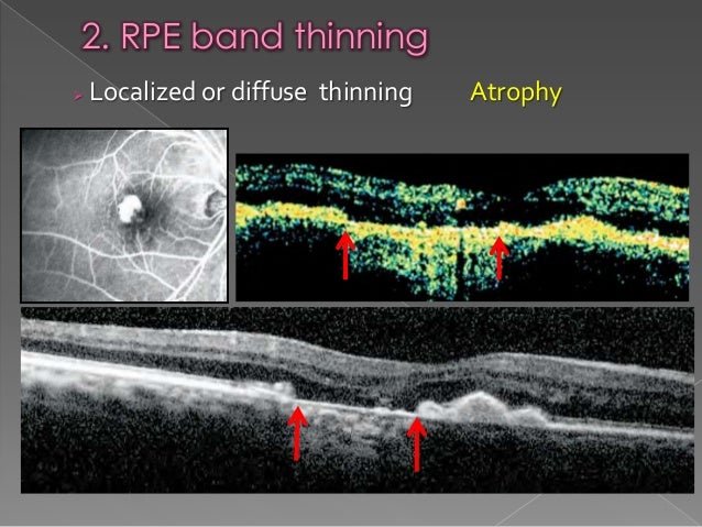 RPE changes in OCT