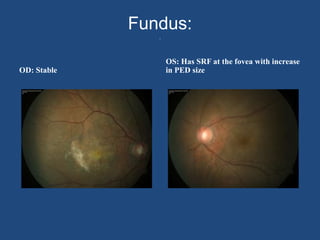 RPE Tear presentations | PPTX