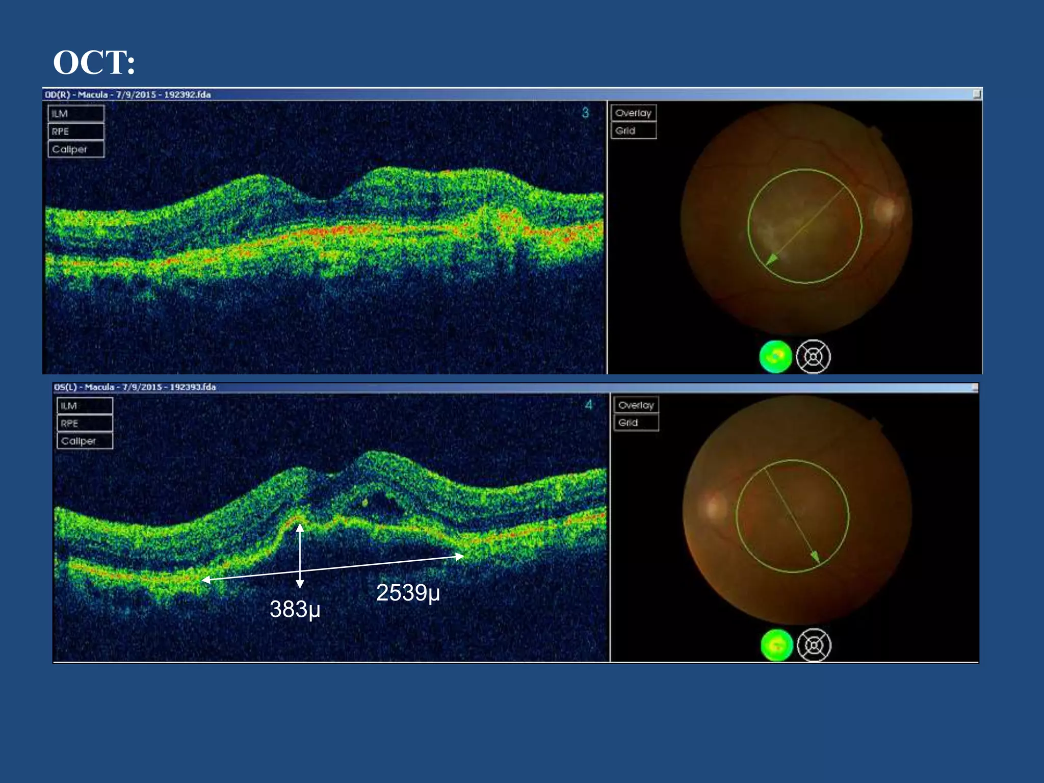 RPE Tear,,,,Retinal Pigment Epithelium Tear.pptx