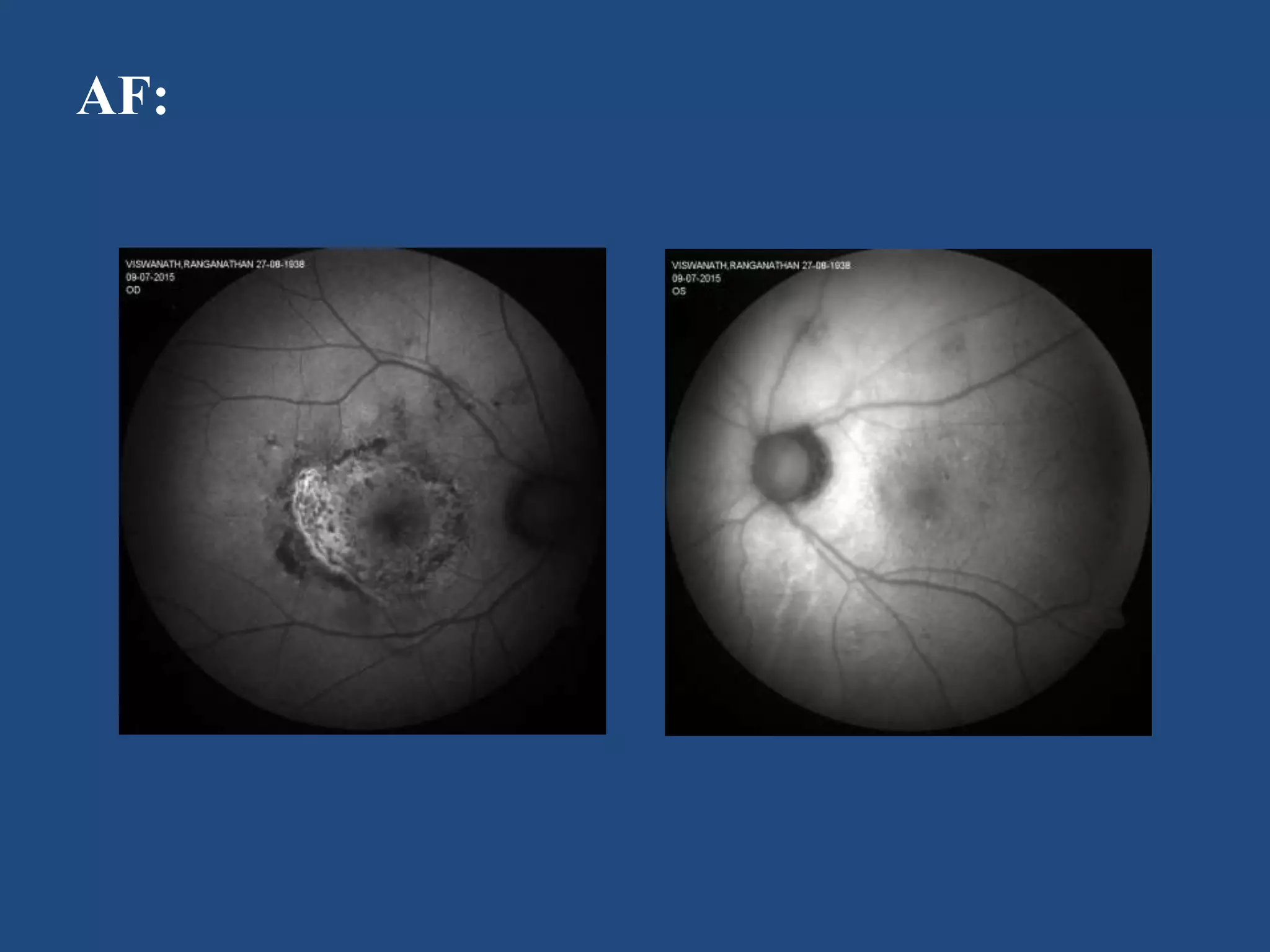 RPE Tear,,,,Retinal Pigment Epithelium Tear.pptx