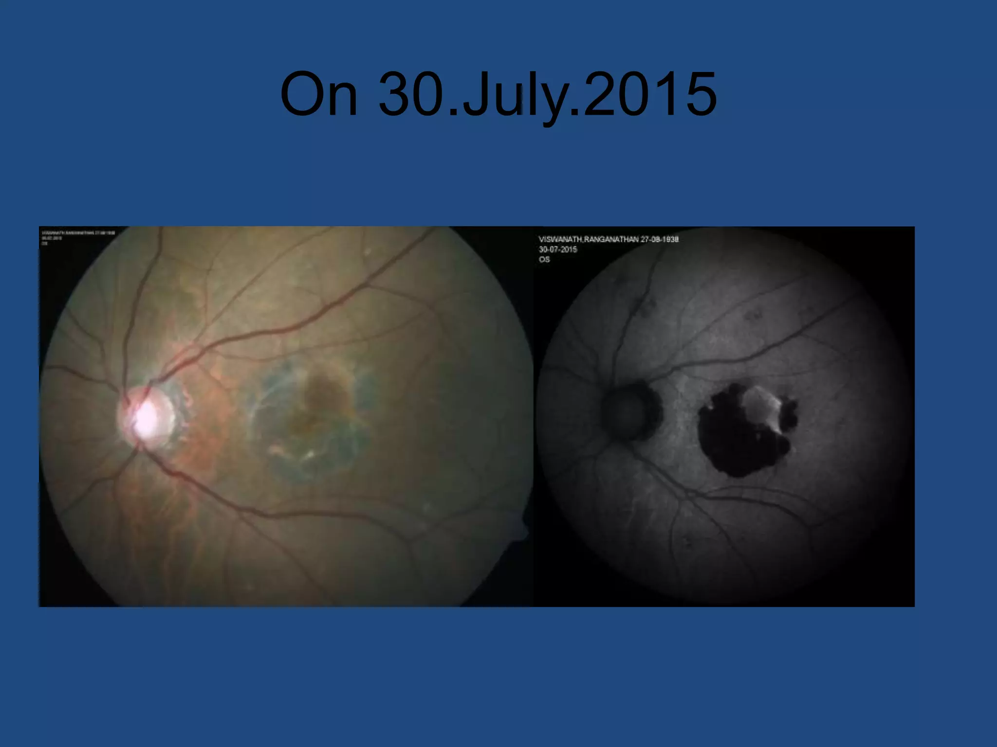 RPE Tear,,,,Retinal Pigment Epithelium Tear.pptx