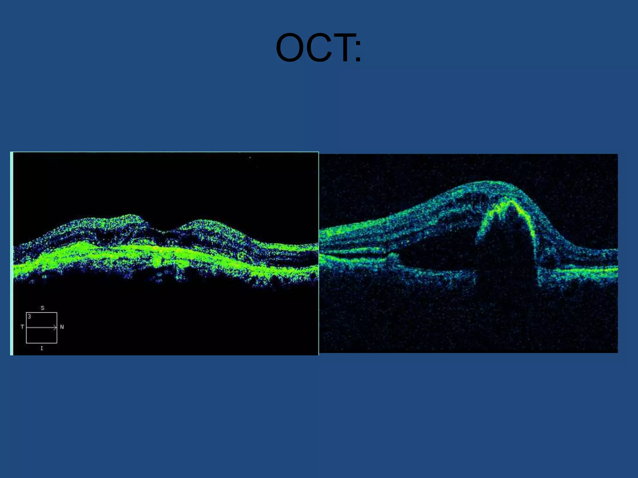 RPE Tear,,,,Retinal Pigment Epithelium Tear.pptx