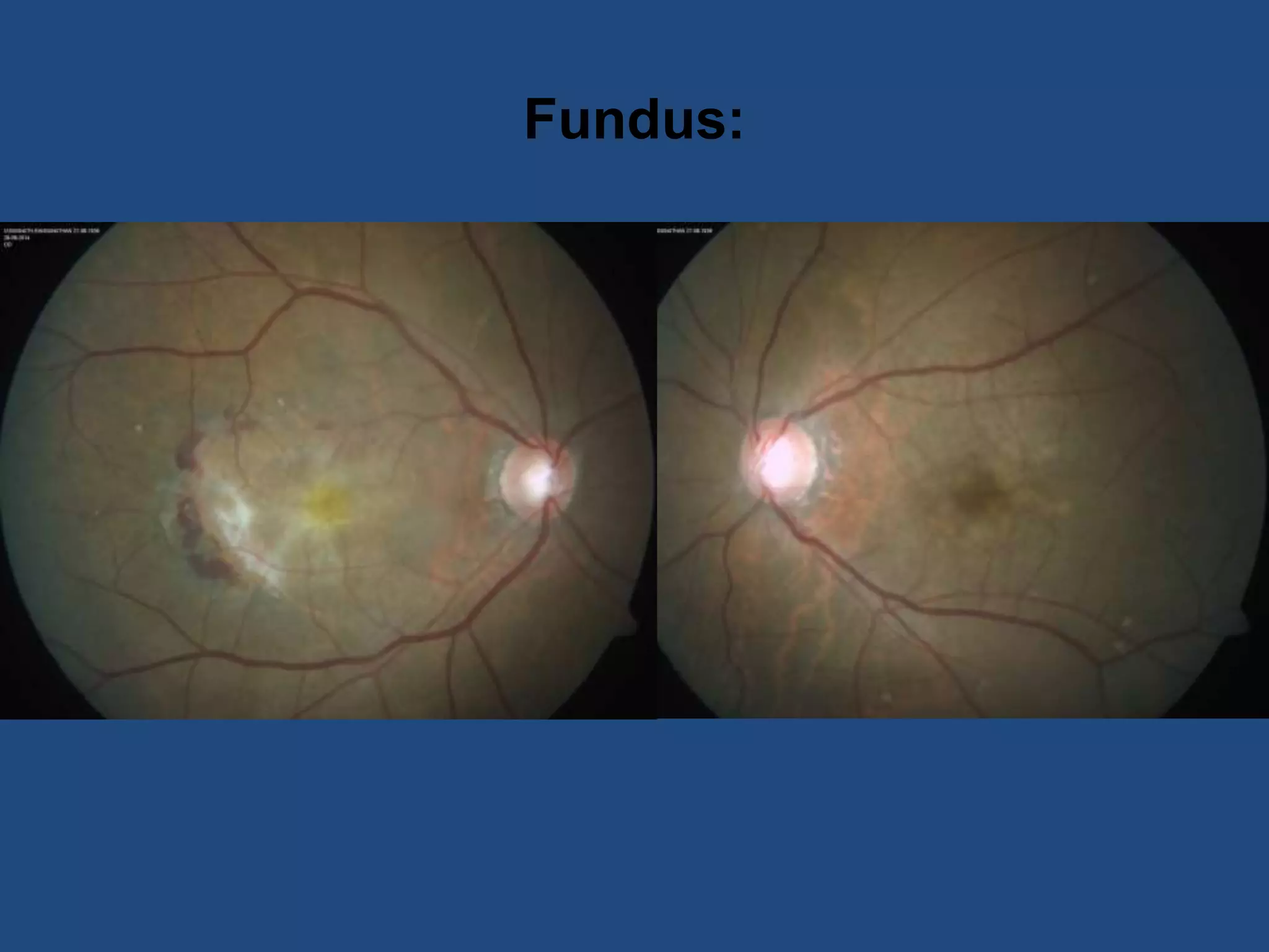 RPE Tear,,,,Retinal Pigment Epithelium Tear.pptx