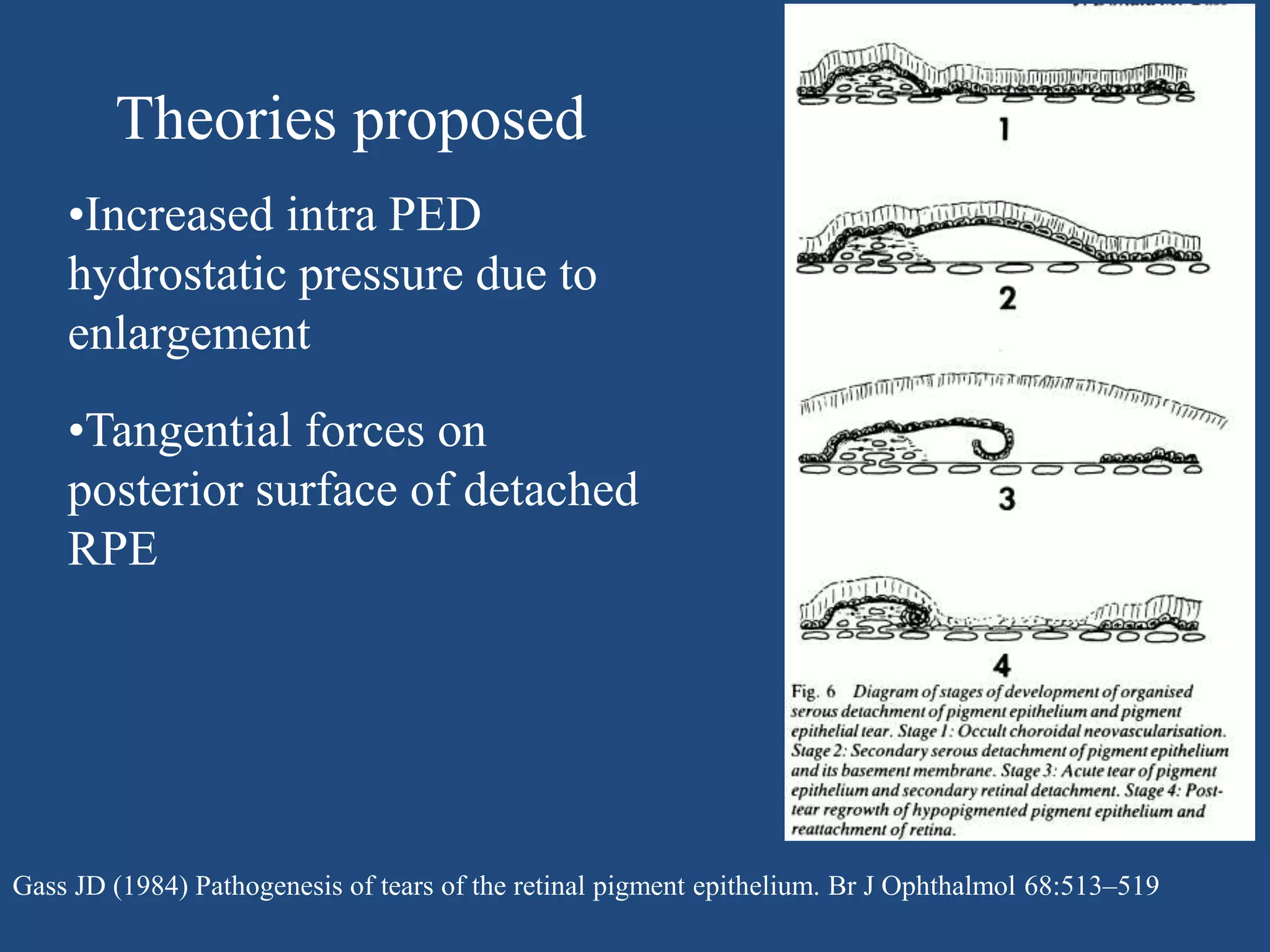 RPE Tear,,,,Retinal Pigment Epithelium Tear.pptx