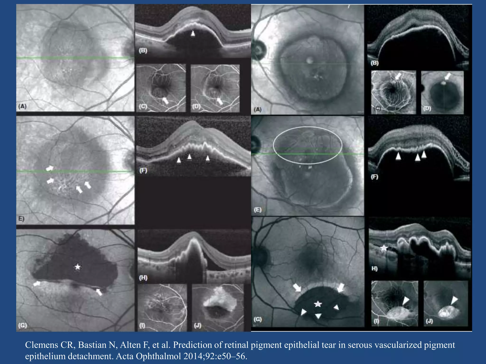 RPE Tear,,,,Retinal Pigment Epithelium Tear.pptx